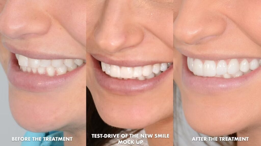 How Much Does a Smile Makeover Cost?